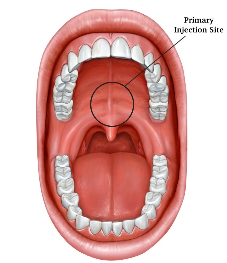 Injection Snoreplasty - Santa Barbara ENT